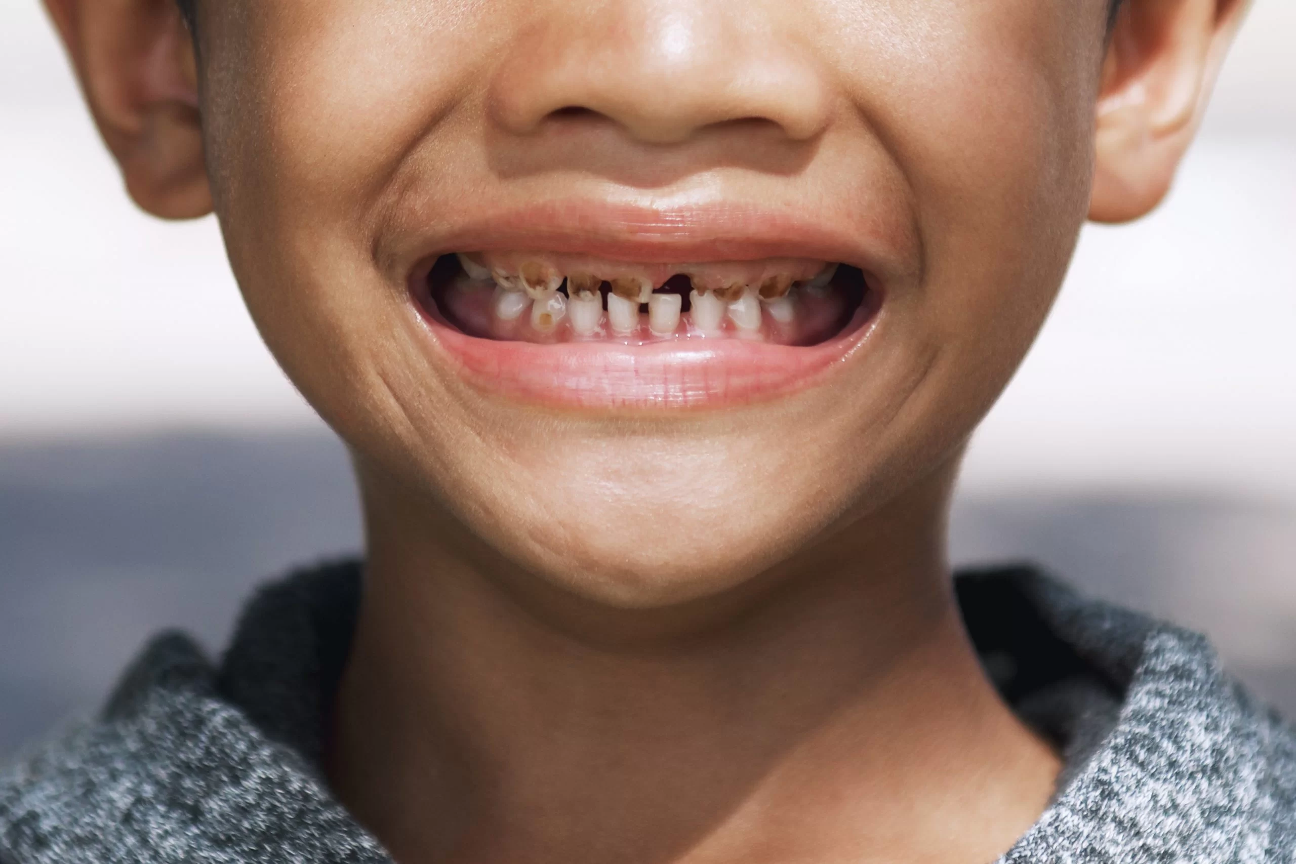 Çocukların Dişlerinin Çürümemesi İçin Dikkat Edilmesi Gerekenler!